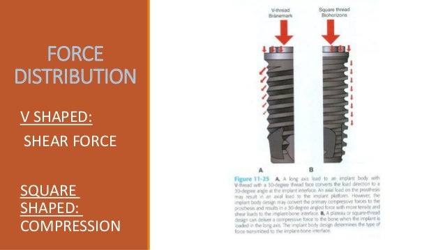 Dental implant deisgn