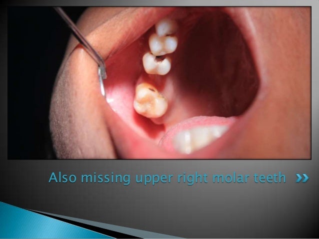 Dental implant for long term missing molar teeth
