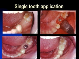 รากฟันเทียมในยุคศตวรรษใหม่ Dental implant in the new millennium | PPT