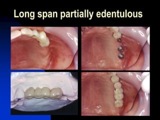 รากฟันเทียมในยุคศตวรรษใหม่ Dental implant in the new millennium | PPT