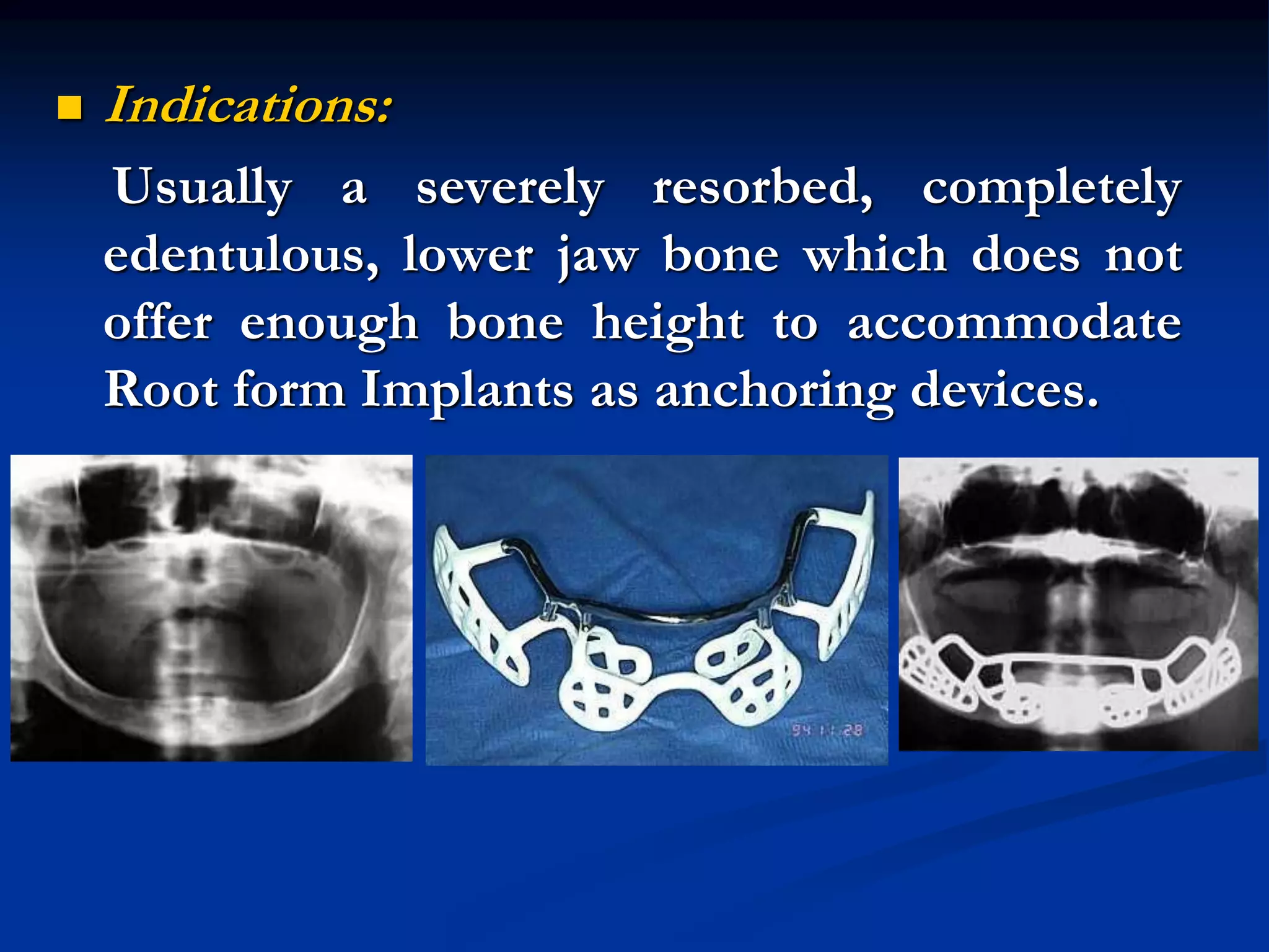 Dental Implant Introduction.ppt