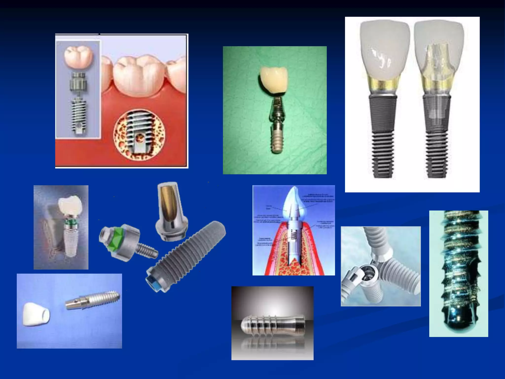 Dental Implant Introduction.ppt
