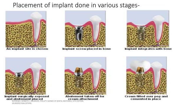 Dental implant materials | PPTX