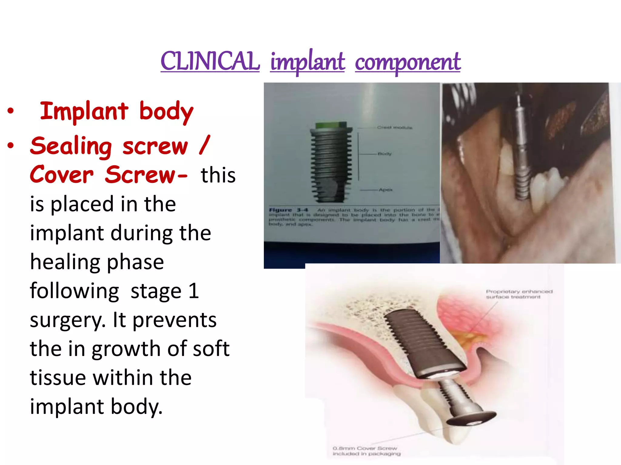 Dental implants | PPTX