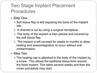 Dental Implants | PPT