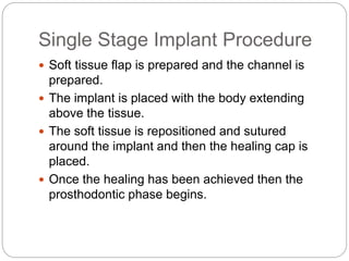 Dental Implants | PPT