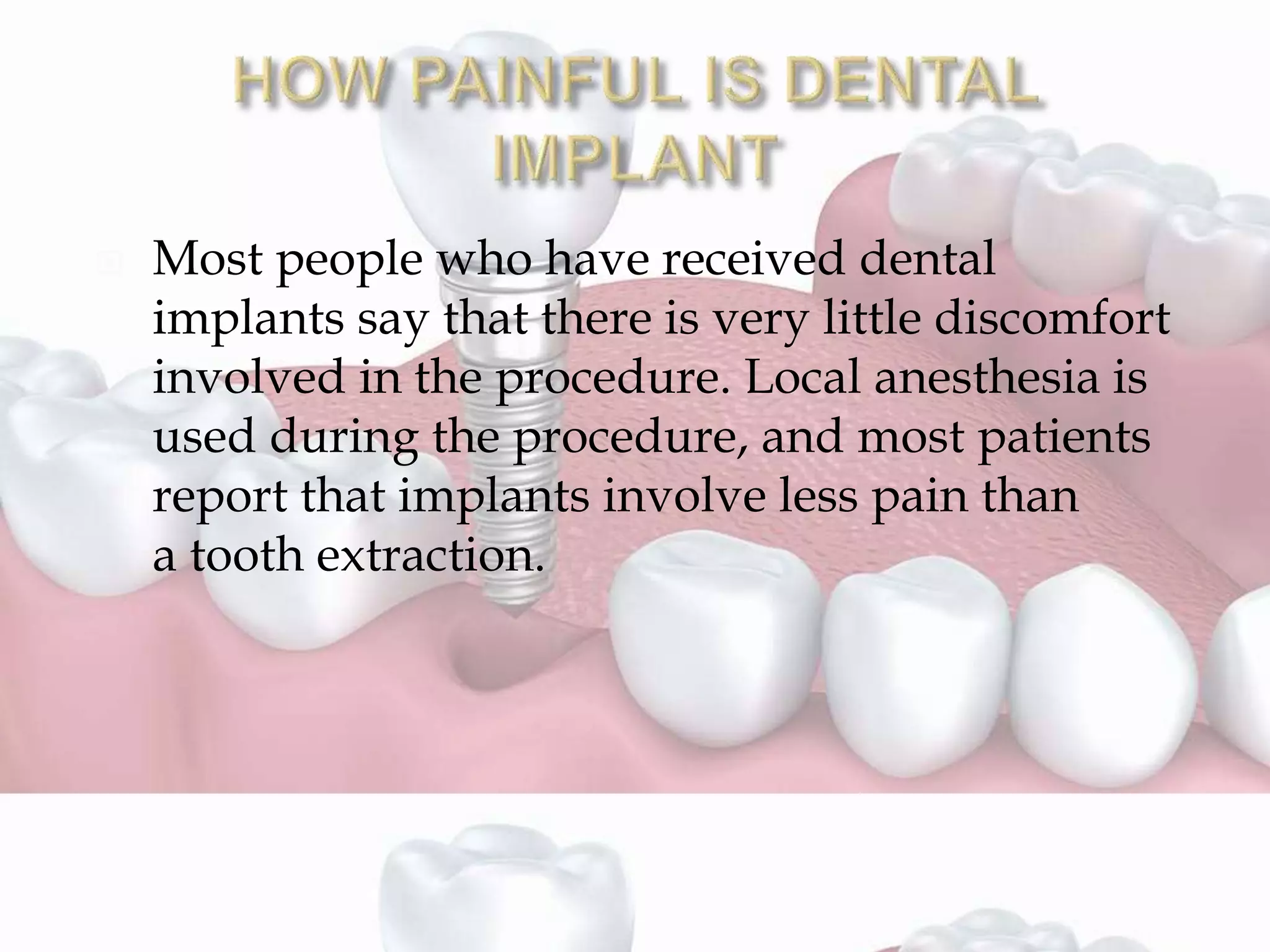 Dental implants | PPT