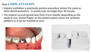 Dental implants | PPT