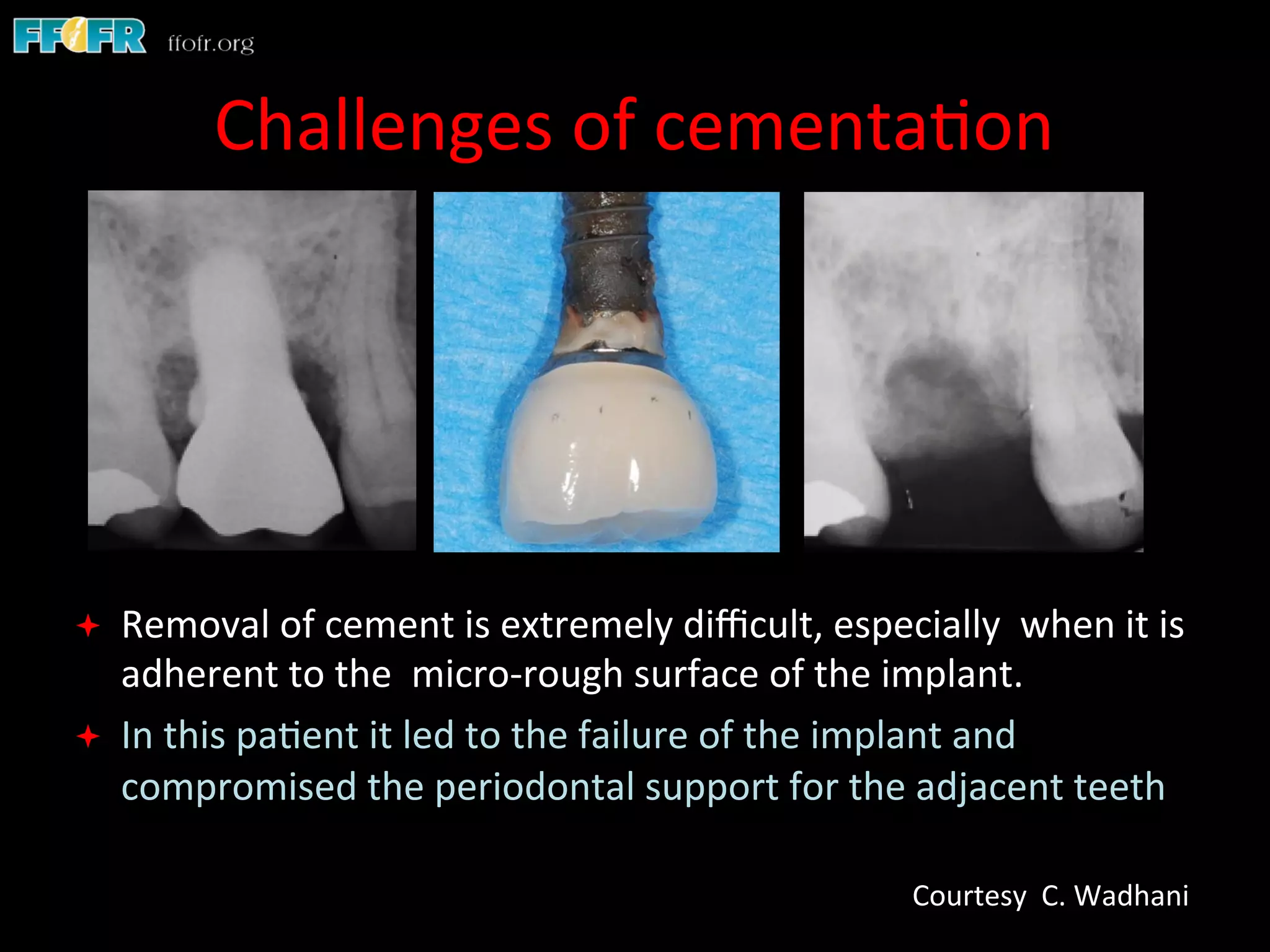 Dental implants cement retention vs screw retention | PDF