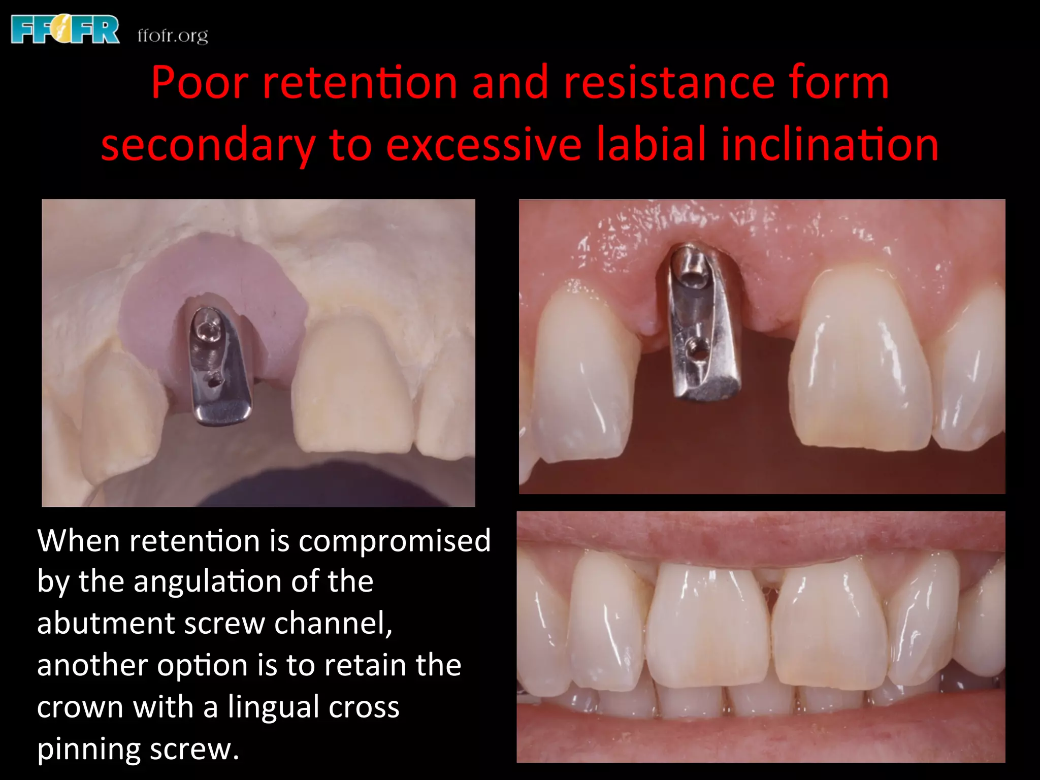 Dental implants cement retention vs screw retention | PDF