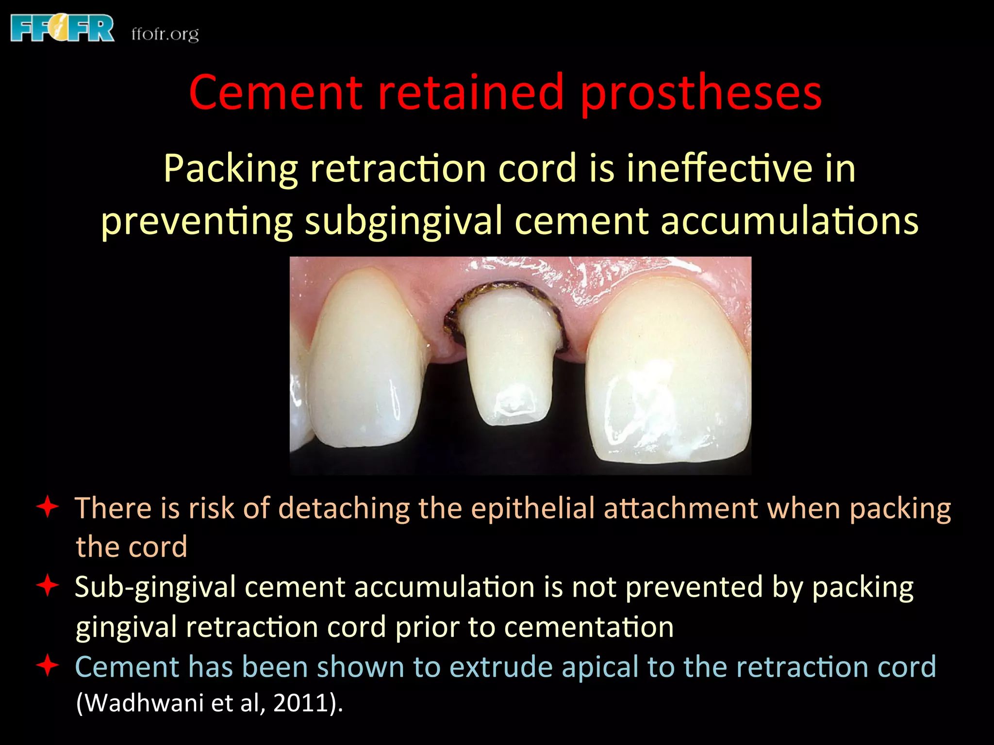 Dental implants cement retention vs screw retention | PDF