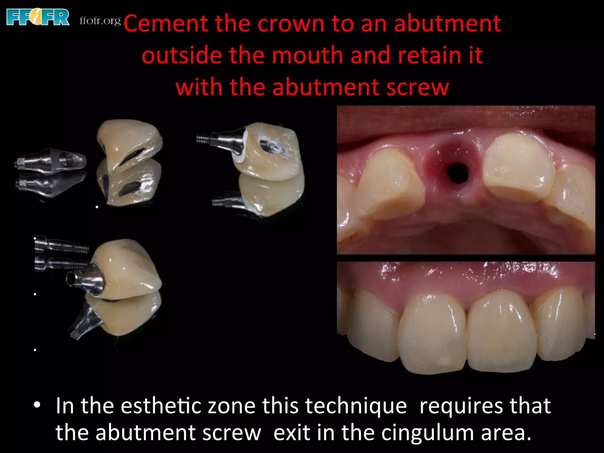 Dental implants cement retention vs screw retention | PDF