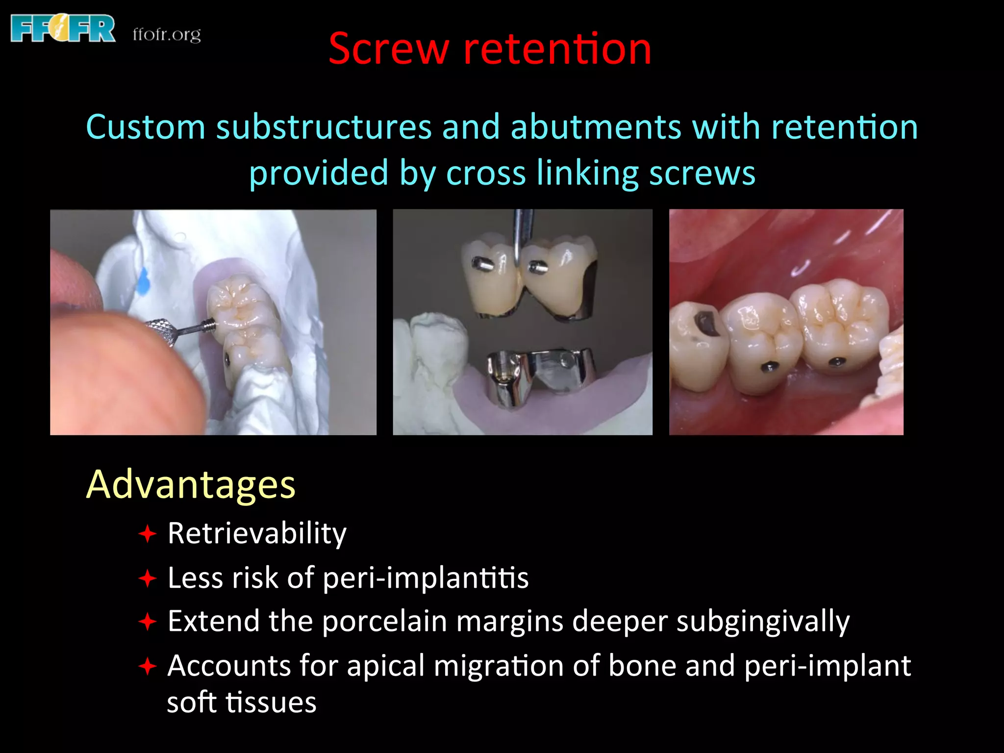 Dental implants cement retention vs screw retention | PDF