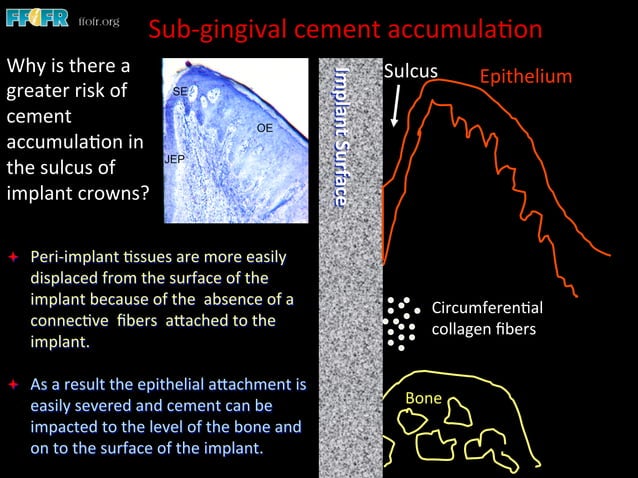 Dental implants cement retention vs screw retention | PDF | Oral care ...