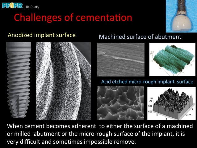 Dental implants cement retention vs screw retention | PDF | Oral care ...