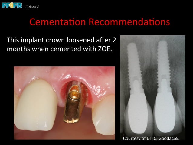 Dental implants cement retention vs screw retention | PDF | Oral care ...