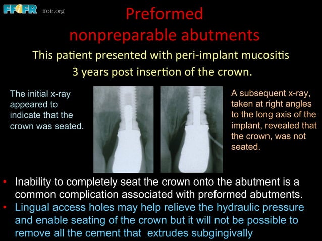 Dental implants cement retention vs screw retention | PDF | Oral care ...
