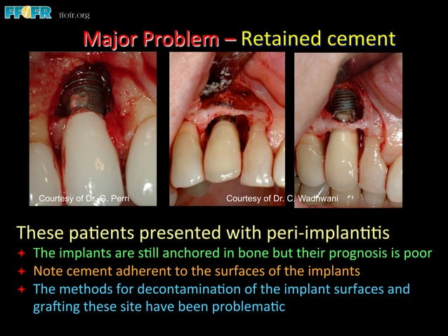 Dental implants cement retention vs screw retention | PDF | Oral care ...