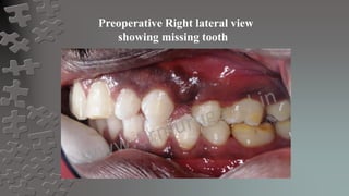 Dental implants ideal replacement to tooth supported dental bridges ...