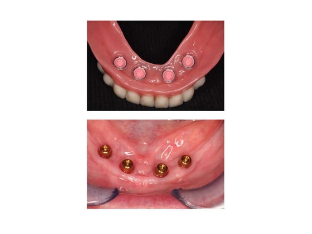 Dental implants,Implant overdentures & impression techniques . | PPTX
