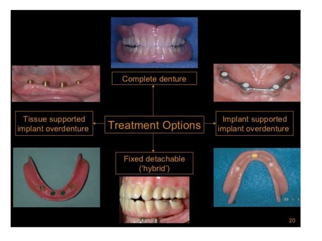 Dental implants,Implant overdentures & impression techniques . | PPTX