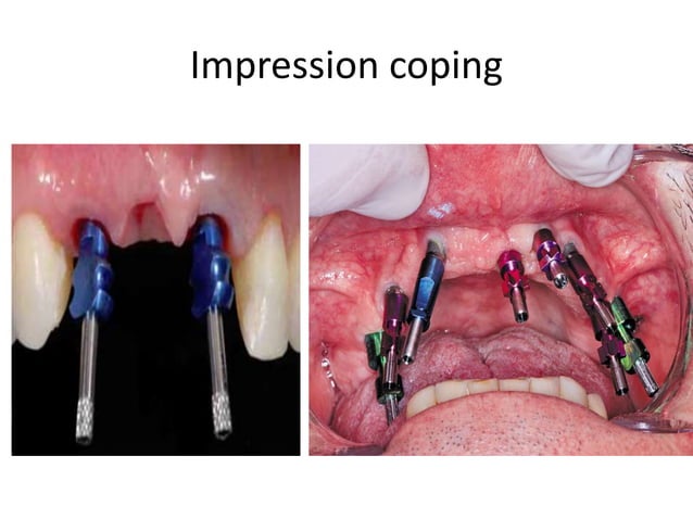 Dental implants,Implant overdentures & impression techniques . | PPTX
