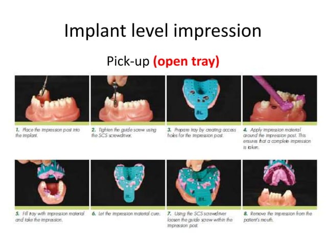 Dental implants,Implant overdentures & impression techniques