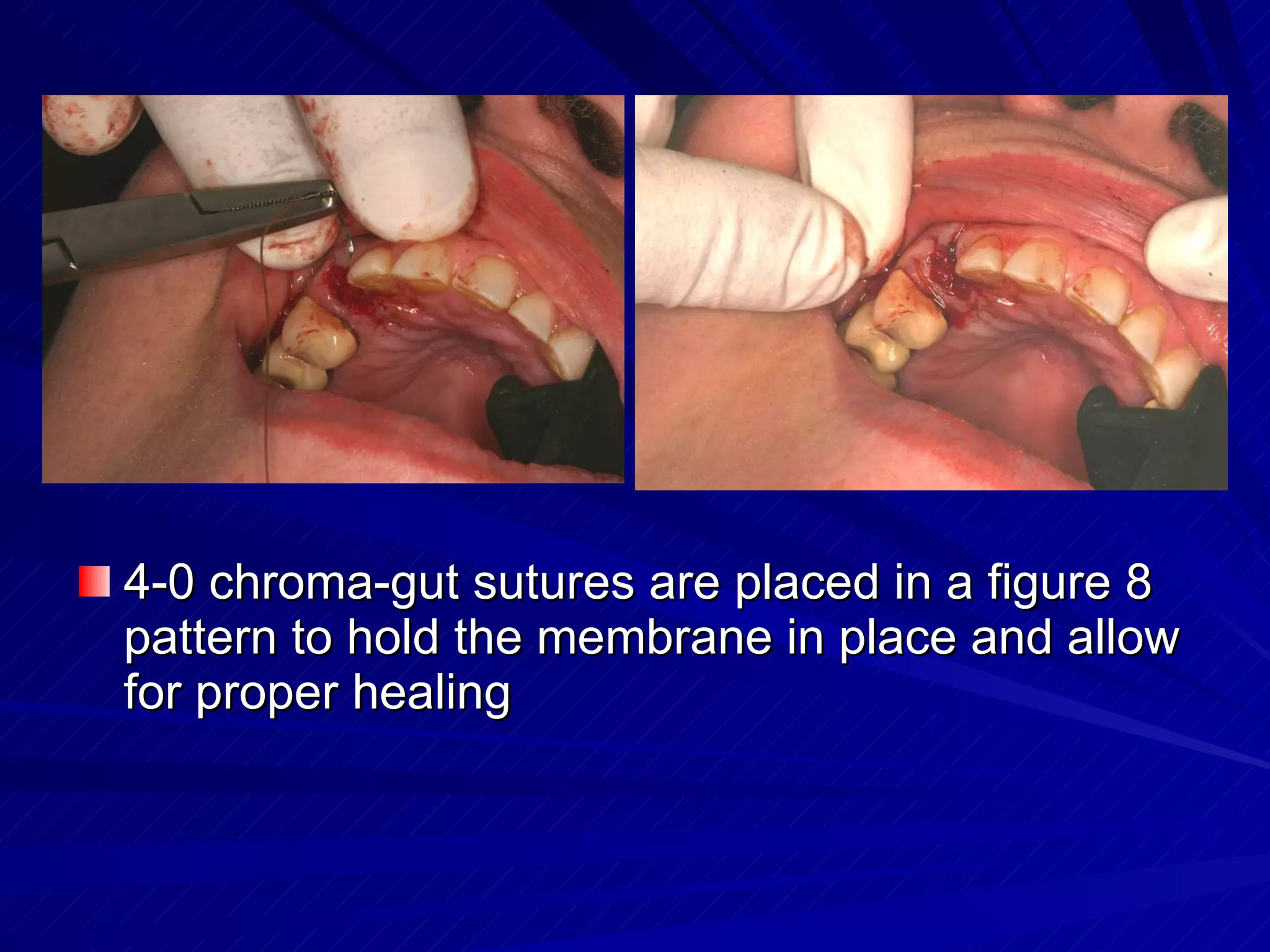 Dental Implants Socket Preservation | PPT
