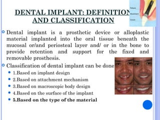 Dental implants and material | PPT