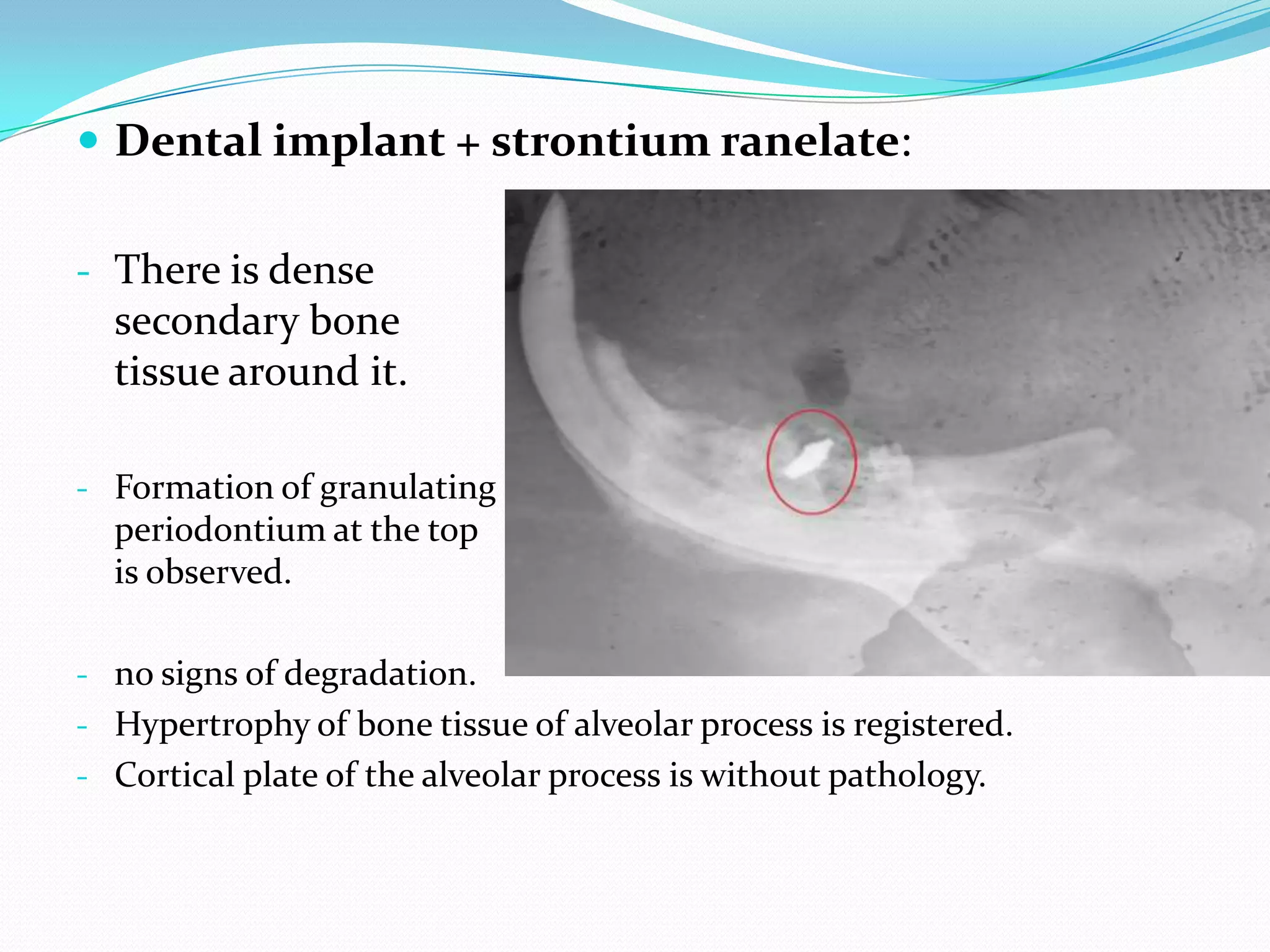 Dental Implants and Osteoporosis | PPTX