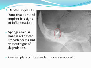 Dental Implants and Osteoporosis | PPTX