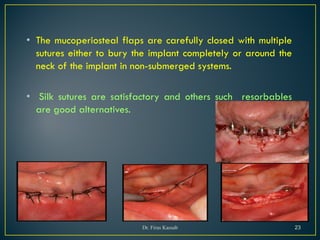 Dental implant surgery | PDF