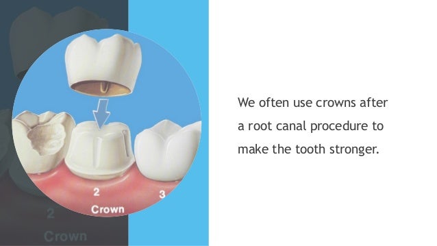 Dental Inlays/Onlays vs Crowns - Which is Better?