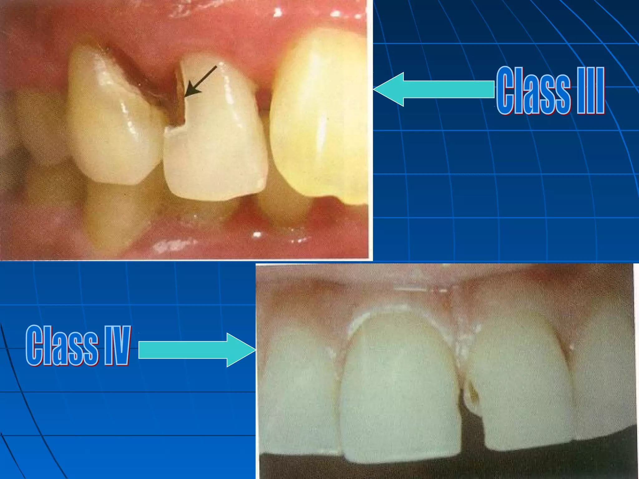 Dental interproximal caries | PPT