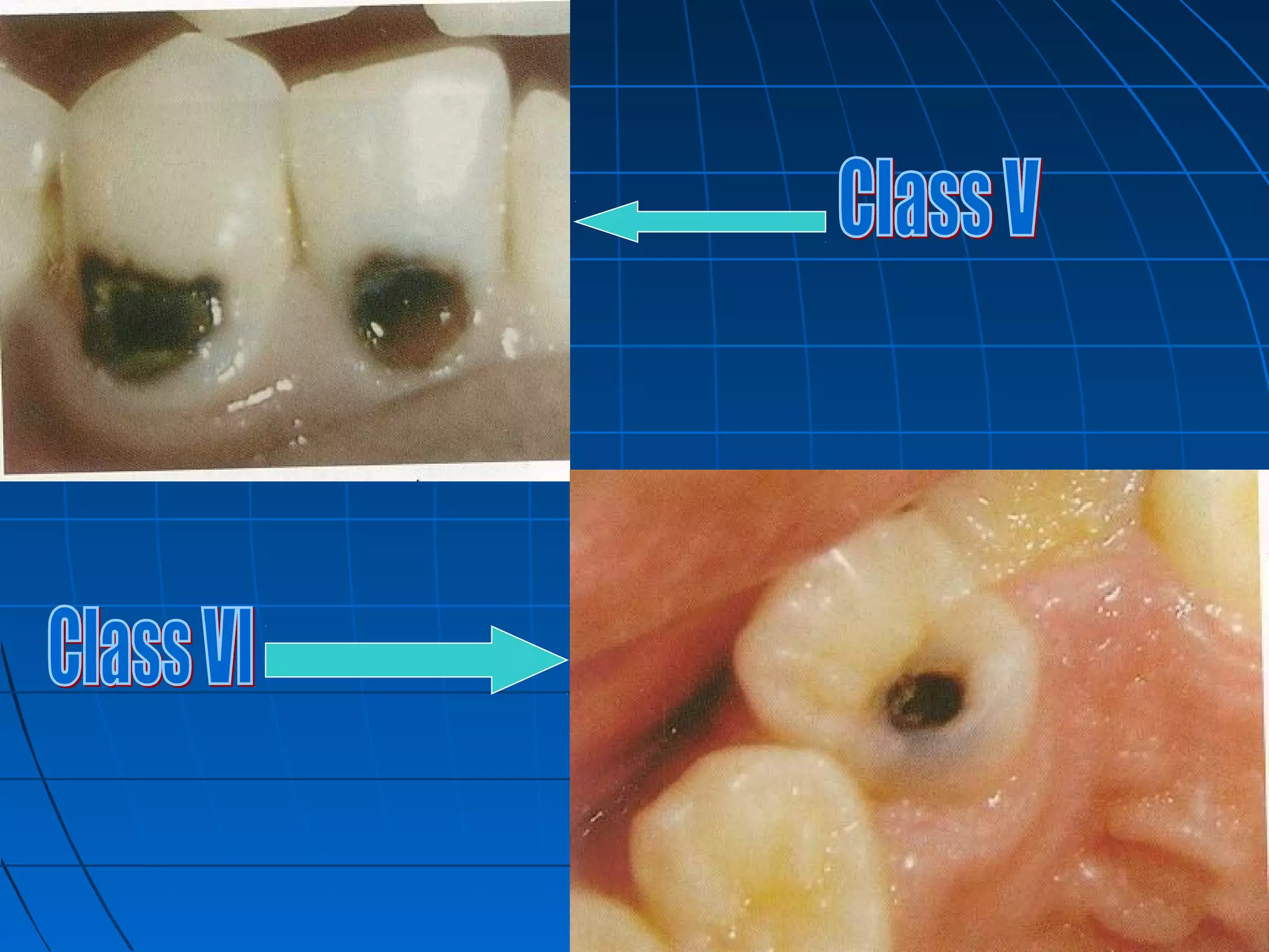 Dental interproximal caries | PPT