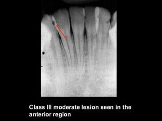 Dental interproximal caries | PPT | Dental Health | Diseases and Conditions