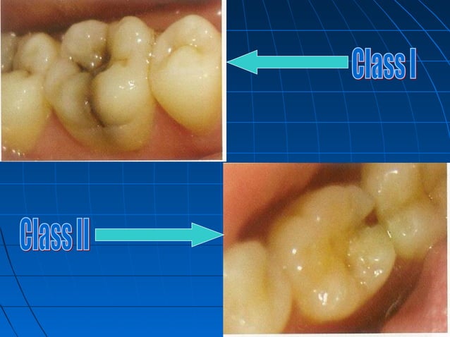 Dental interproximal caries | PPT