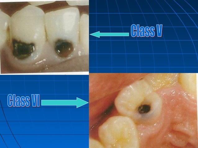 Dental interproximal caries | PPT