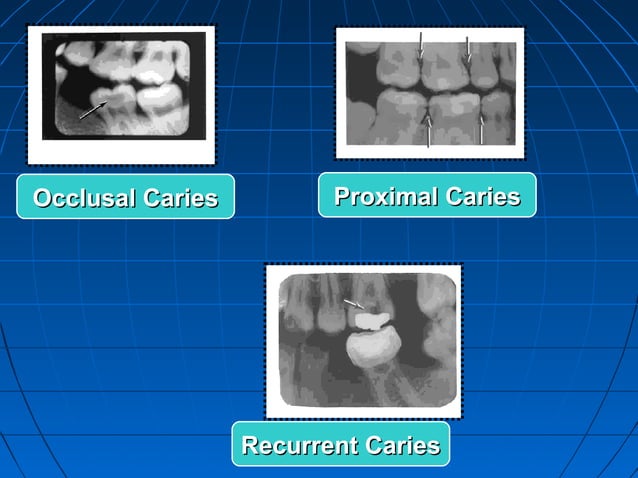 Dental interproximal caries | PPT