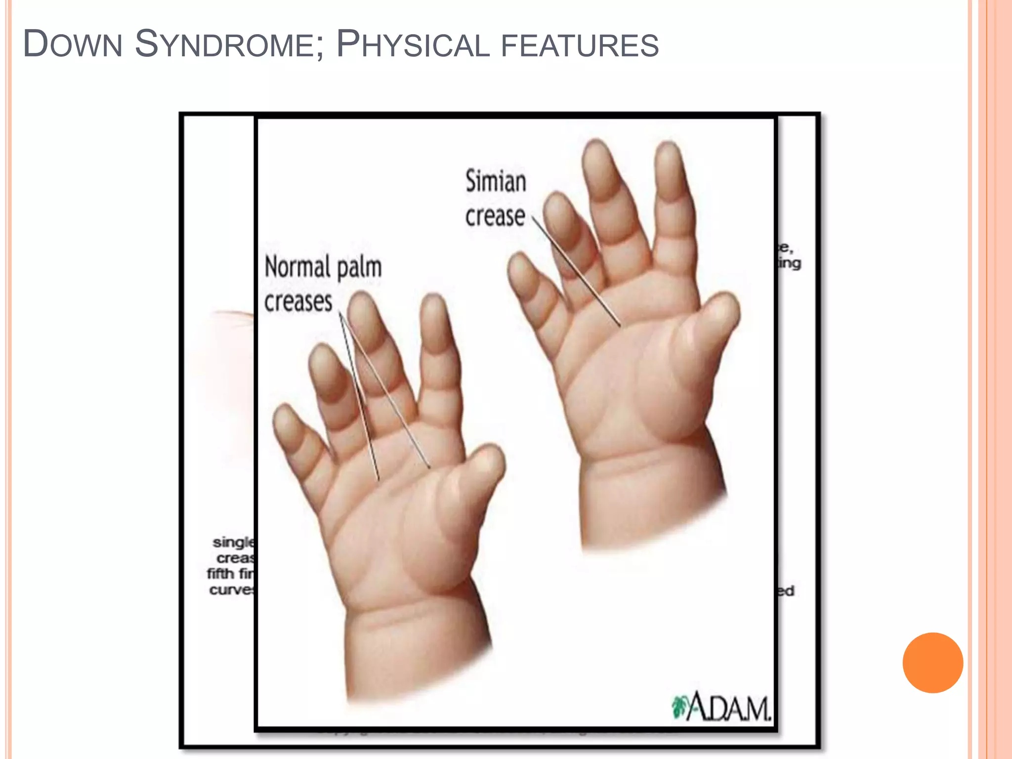 Dental management downs syndrome, fetal alcohol syndrome | PPTX