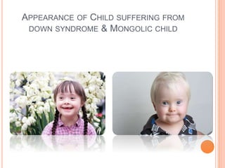 Mongolian Syndrome
