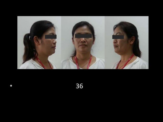Dental management in thyroid patient | PPTX | Thyroid Disorders ...