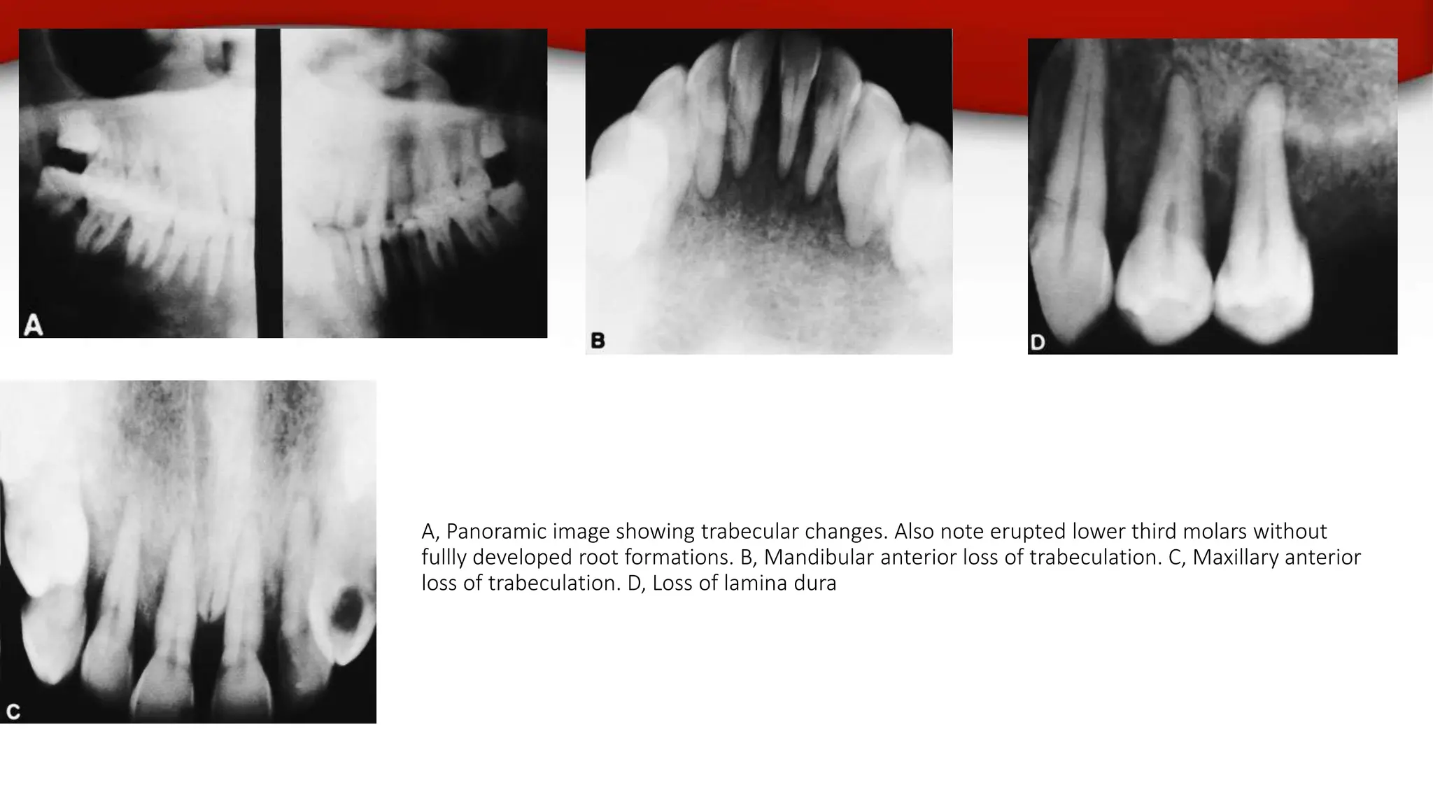 Dental Management of Chronic Renal Failure and Dialysis.pptx