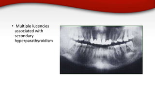 Dental Management of Chronic Renal Failure and Dialysis.pptx