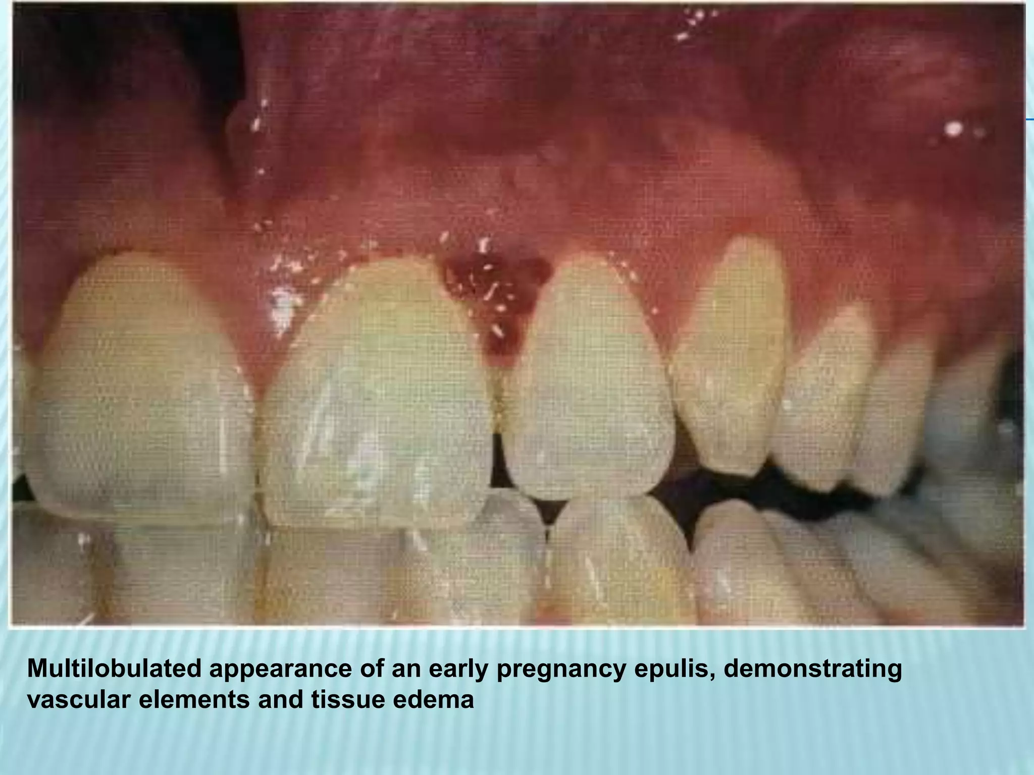 Dental management of pregnant women | PPTX