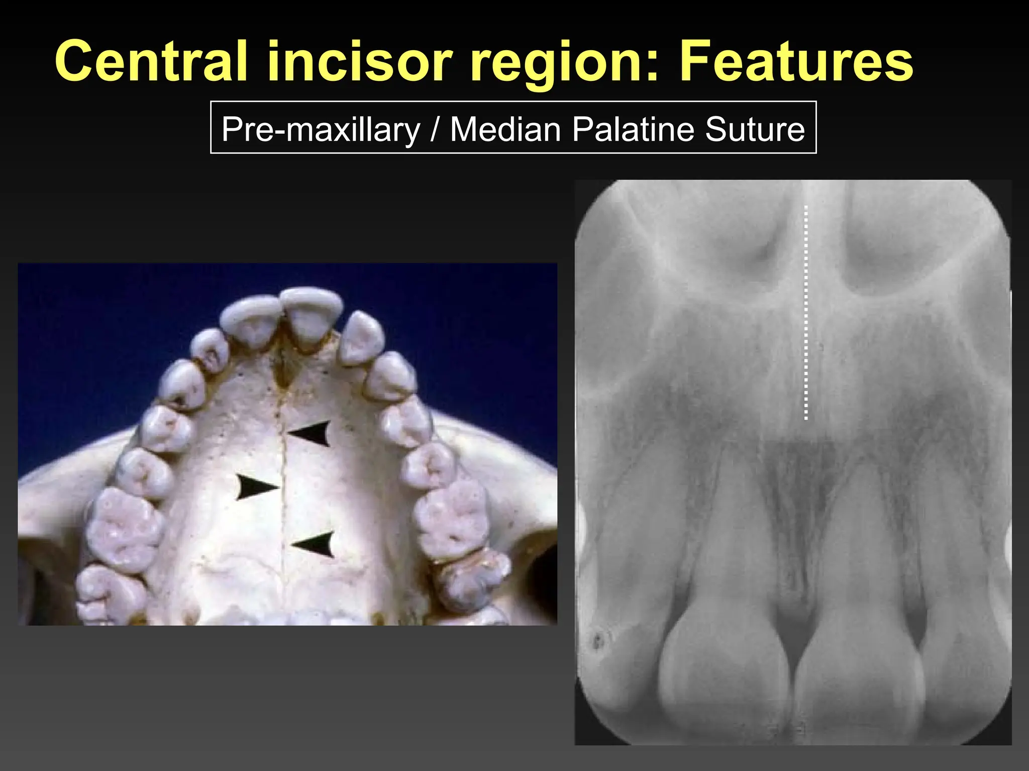 Dental Maxillary and Mandibular Anatomic Radiographic Landmarks.ppt