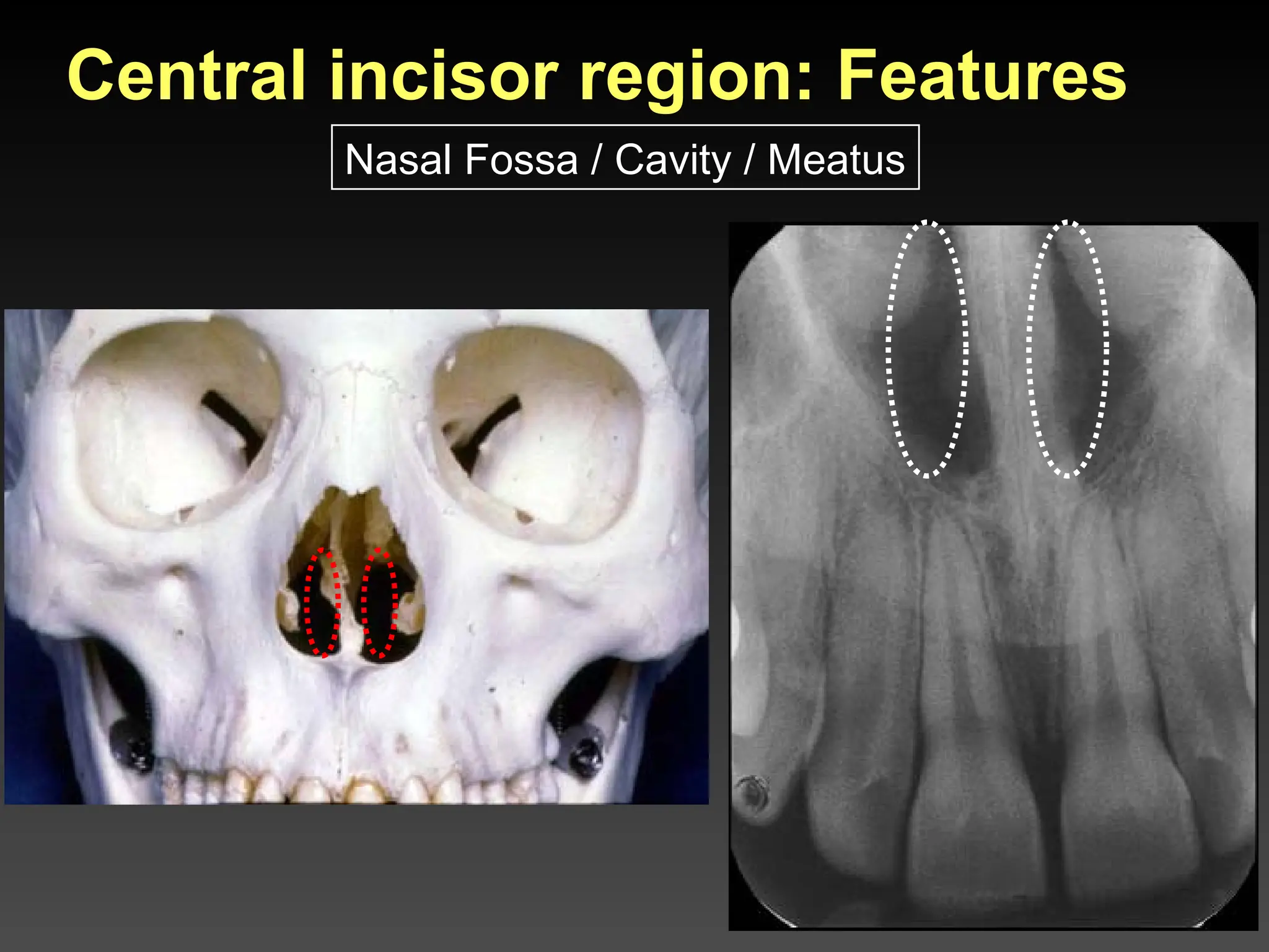 Dental Maxillary and Mandibular Anatomic Radiographic Landmarks.ppt
