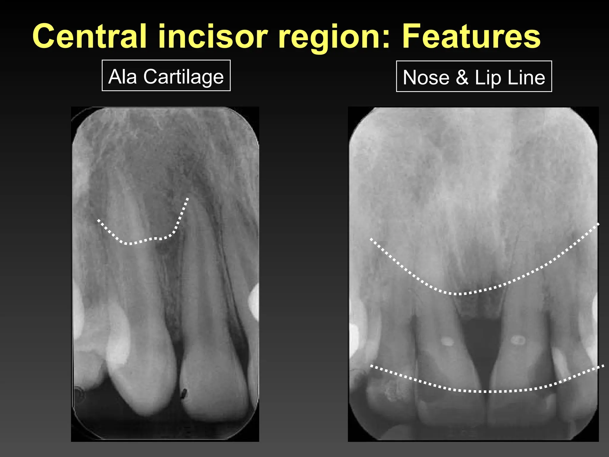 Dental Maxillary and Mandibular Anatomic Radiographic Landmarks.ppt