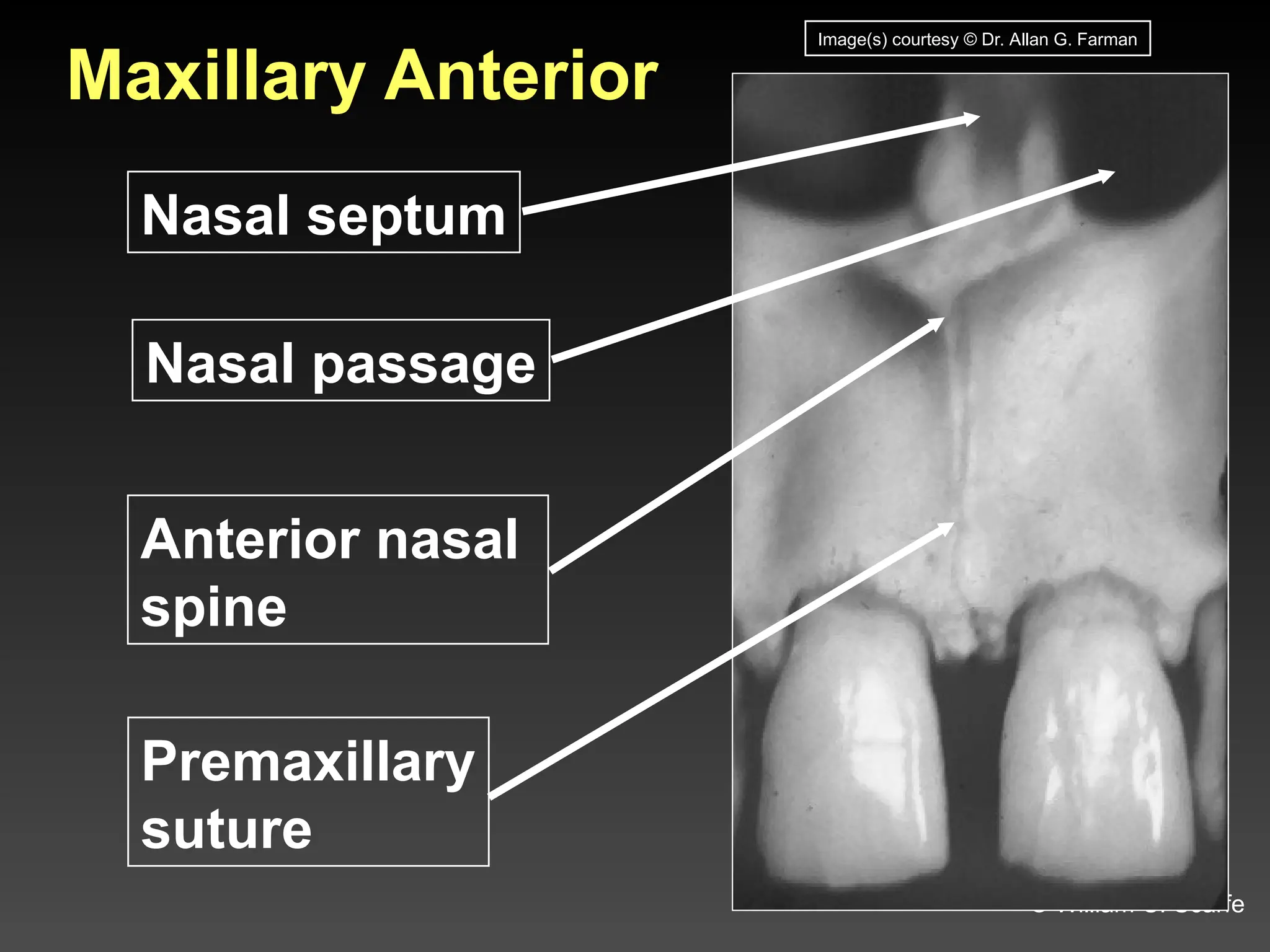 Dental Maxillary and Mandibular Anatomic Radiographic Landmarks.ppt