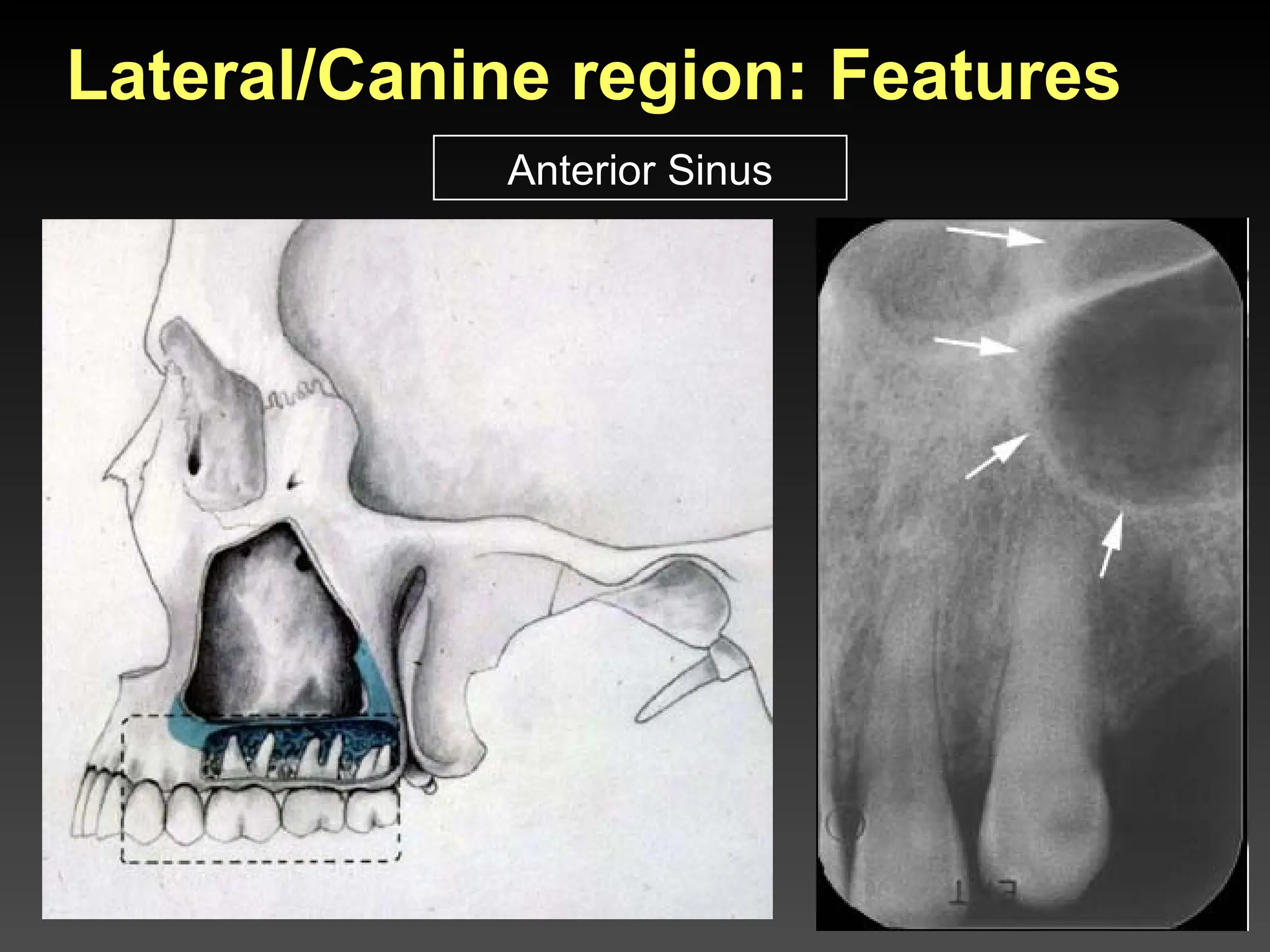 Dental Maxillary and Mandibular Anatomic Radiographic Landmarks.ppt | 3 ...